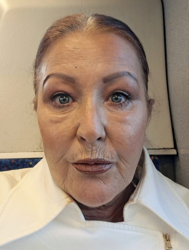 Woman loves £6k Turkey facelift despite cruel online comments