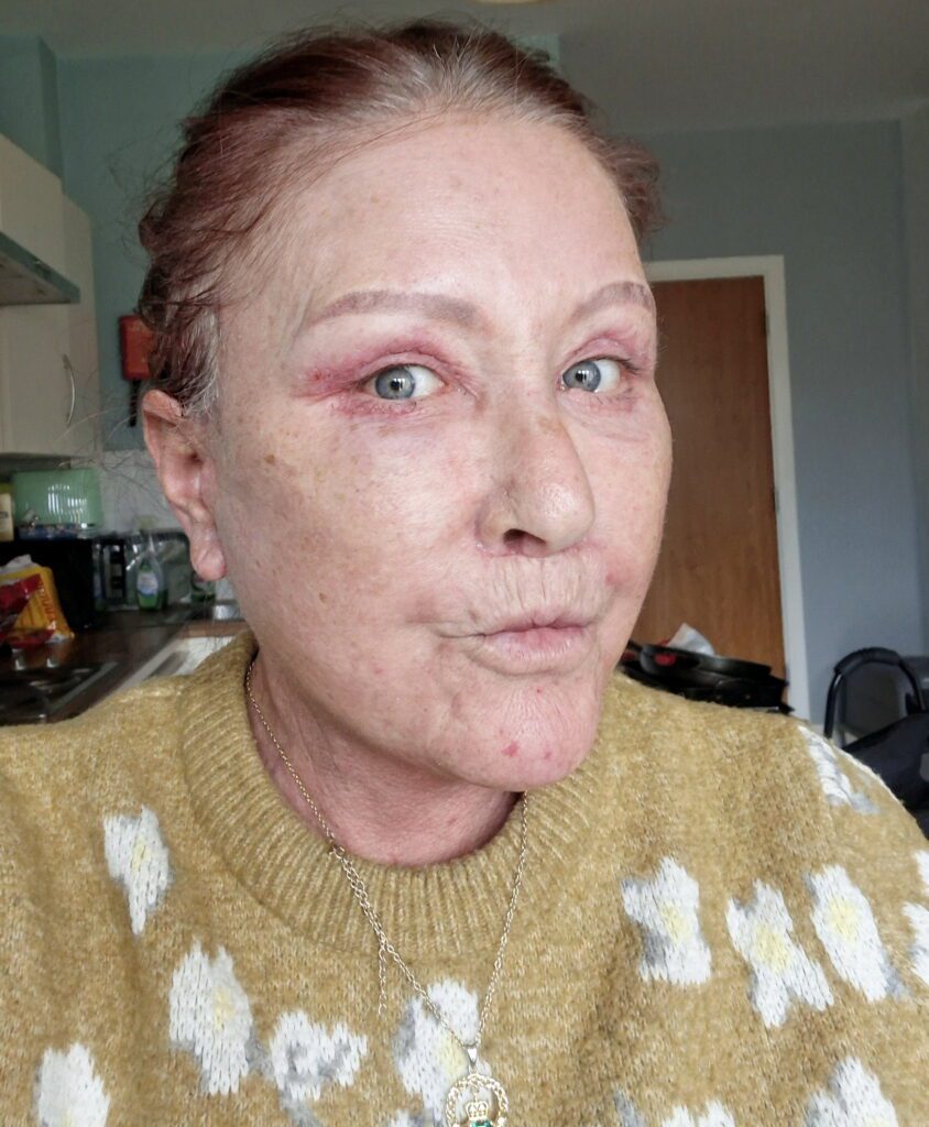 Woman loves £6k Turkey facelift despite cruel online comments