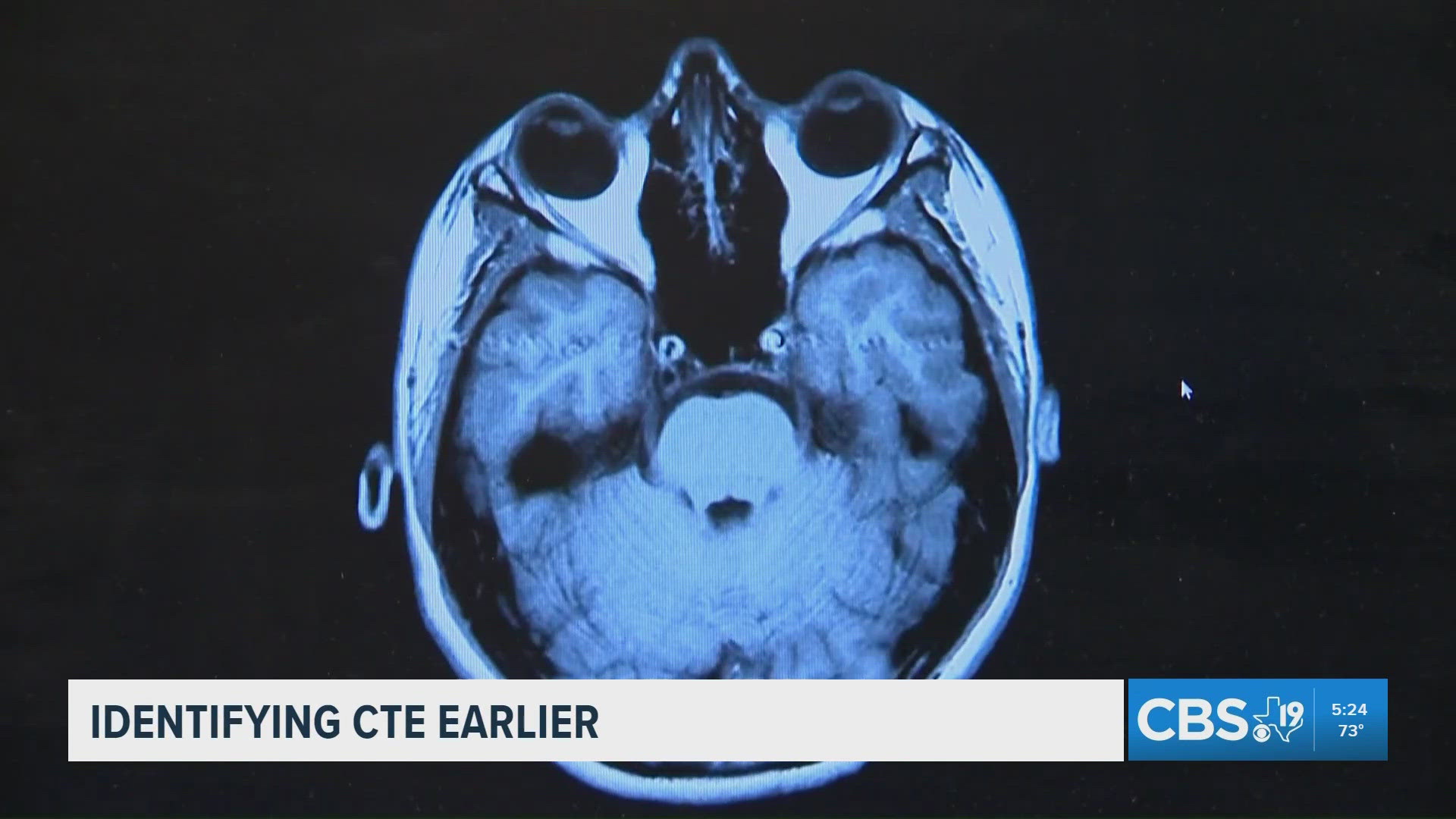 Study suggests PET scan may detect CTE biomarker in living patients