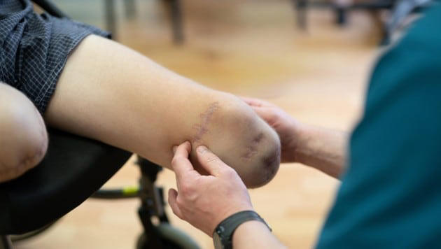 Brite fror Beine ein – weil er Amputation wollte