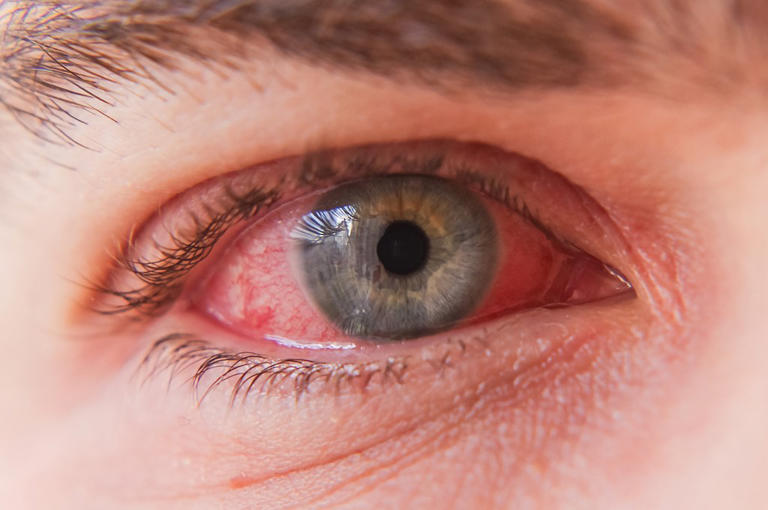 Ophthalmologists reveal surprisingly serious conditions eye rubbing can ...