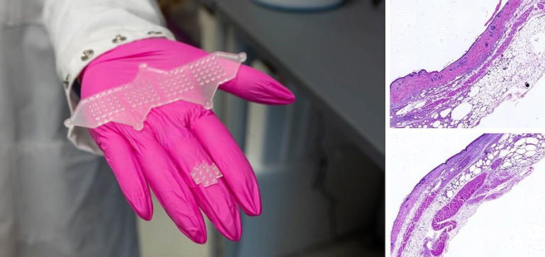 ‘Living bandage’ acelerates healing of wounds