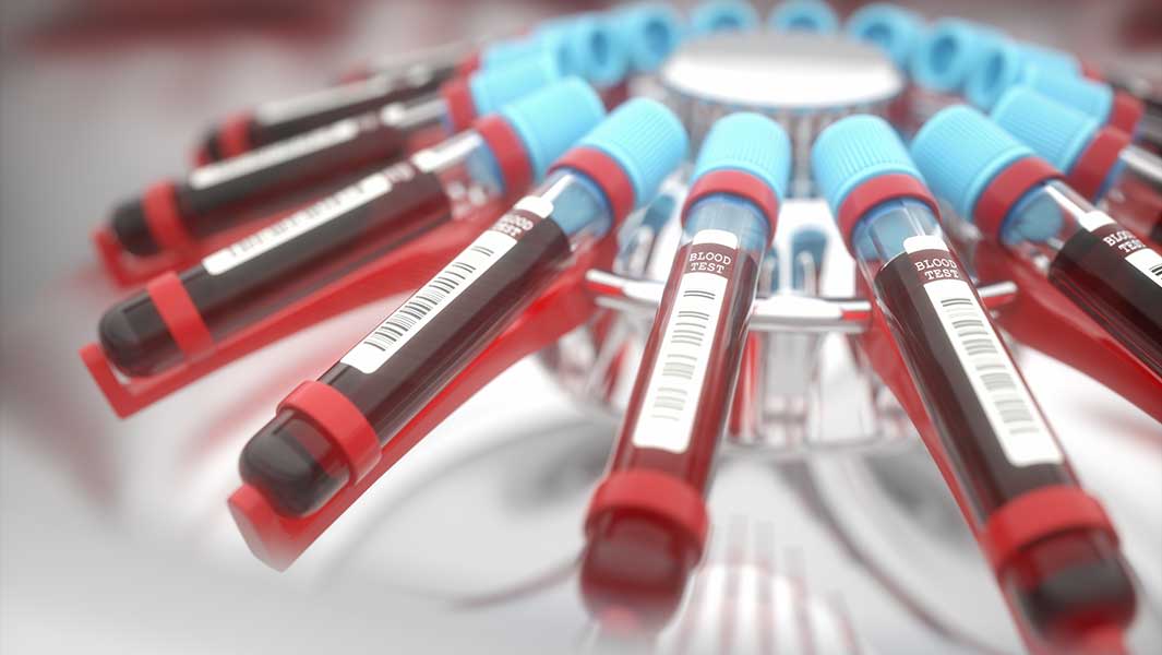 Grail plummets on mixed results for cancer-screening blood test