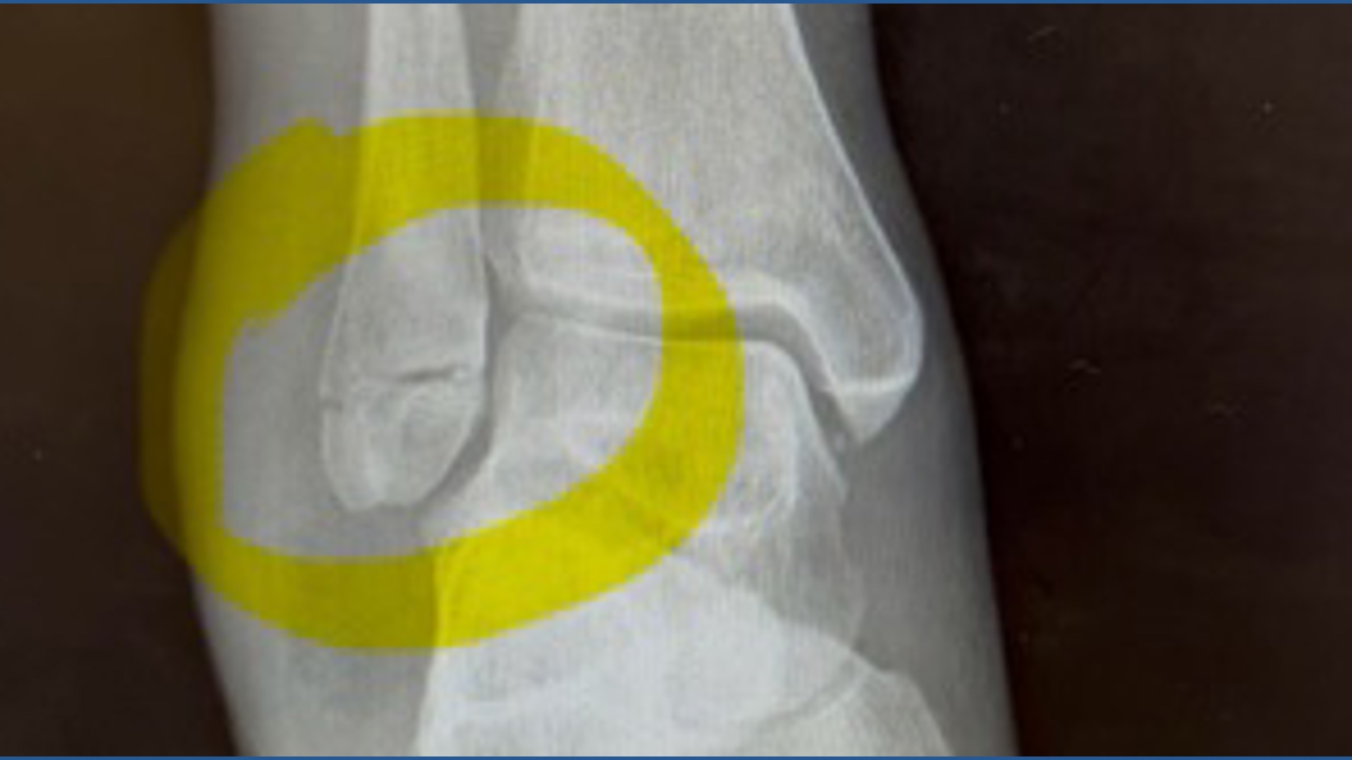 How doctors put on cast for broken fibula