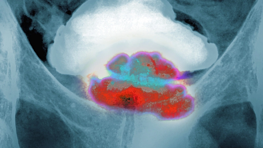 12 silent signs of prostate cancer