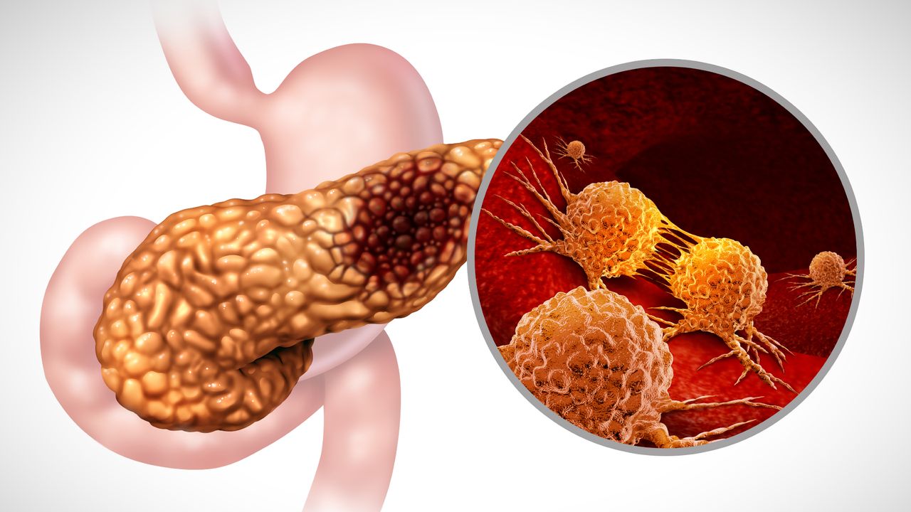 Pill offers hope in treating deadly pancreatic cancer