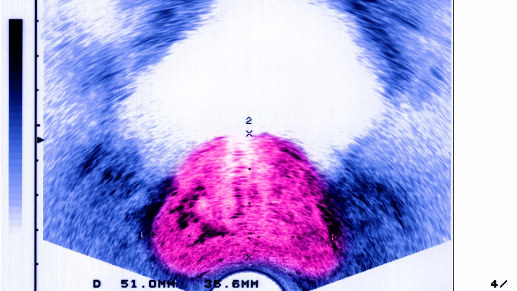 12 silent signs of prostate cancer