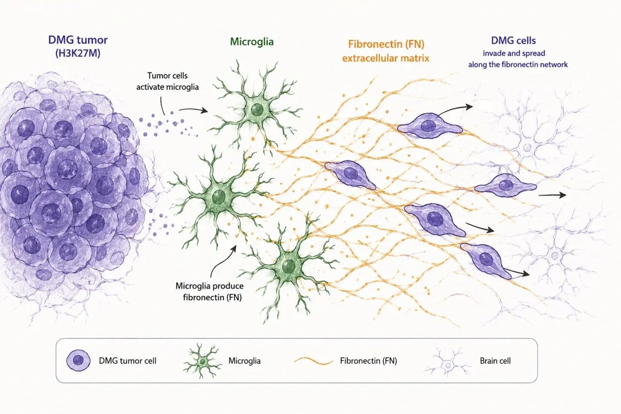 Children's brain tumors may spread faster when microglia build invasion ...
