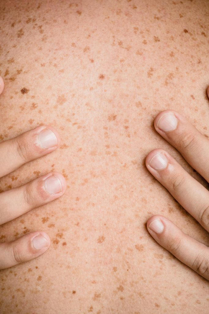 New vaccine slashes risk of skin cancer recurring by nearly half