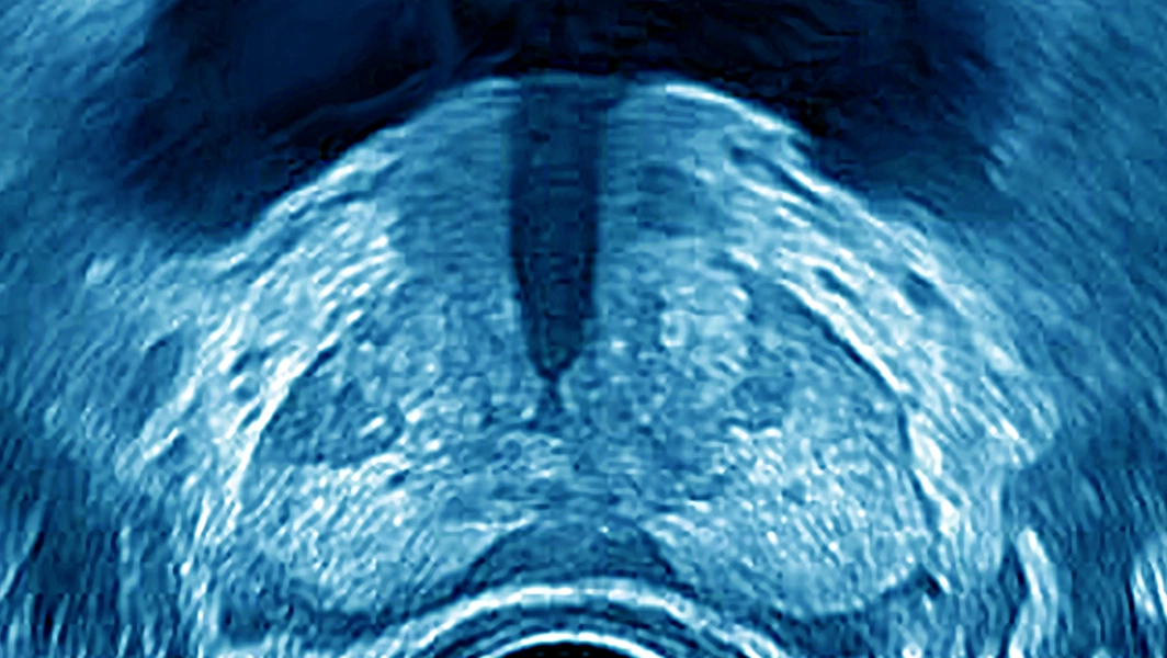 12 silent signs of prostate cancer