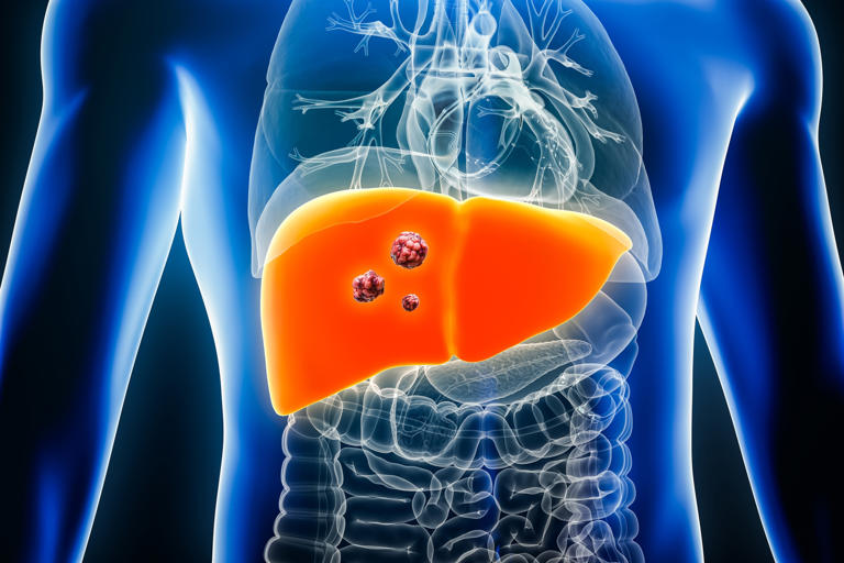 AstraZeneca releases positive Imfinzi + Imjudo results in liver cancer
