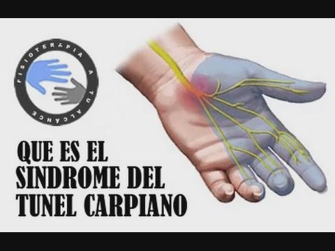Sindrome del tunel carpiano, que es y porque se produce