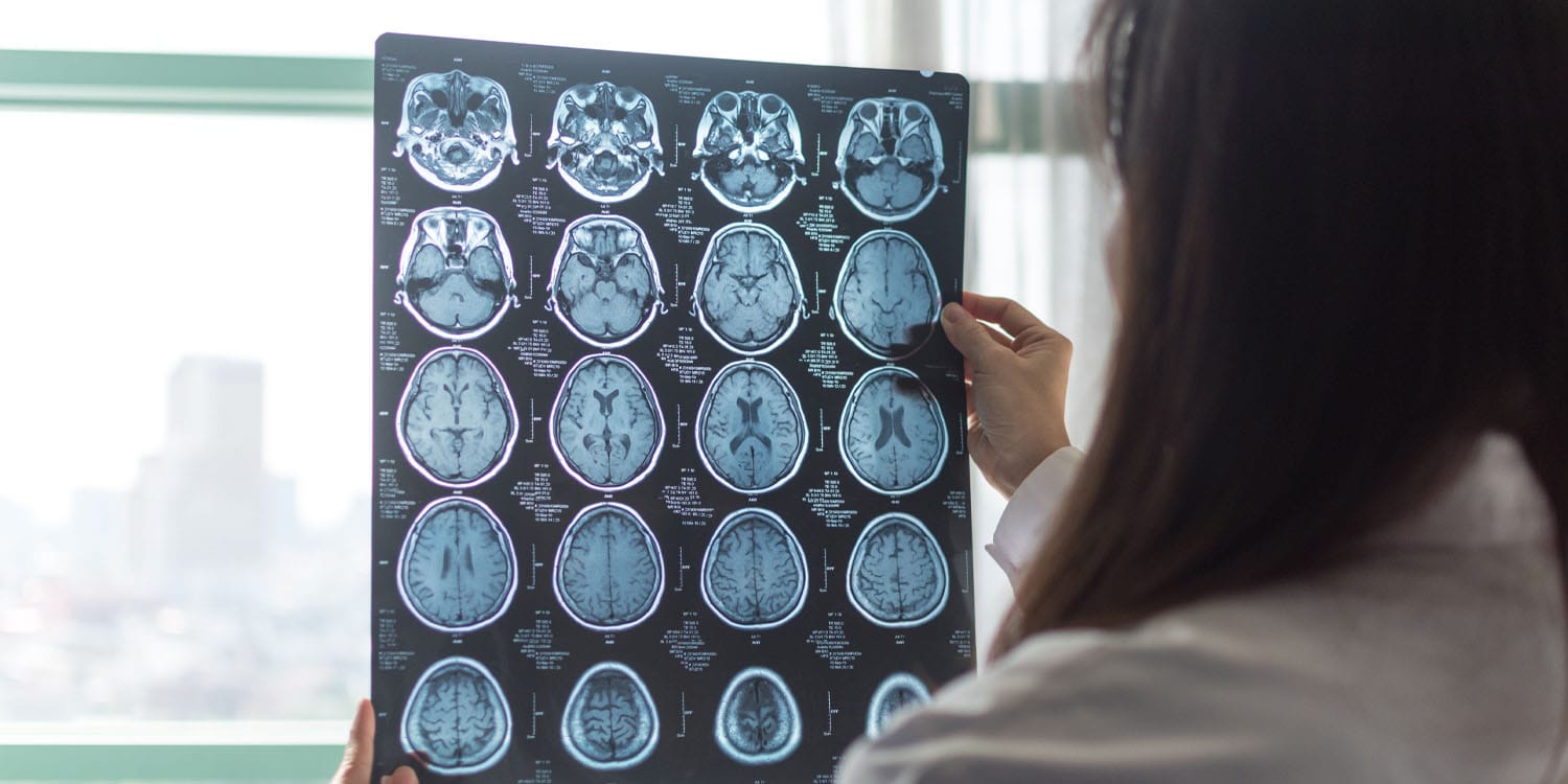 Brain scans link tissue reductions to aggression in schizophrenia
