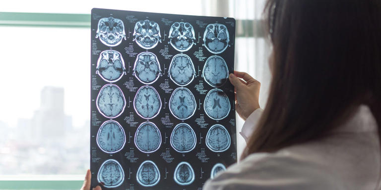 Brain scans link tissue reductions to aggression in schizophrenia