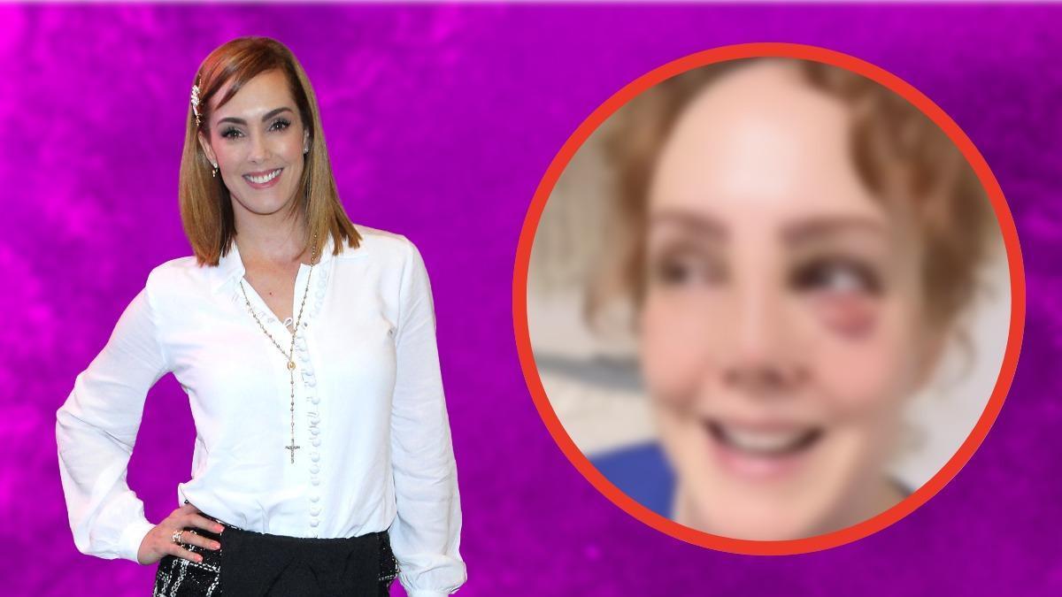 Las fotos de la actriz Fran Meric con un ojo morado que encendieron las ...
