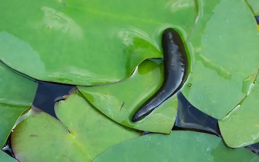 Woman credits leech therapy for decade-long migraine relief
