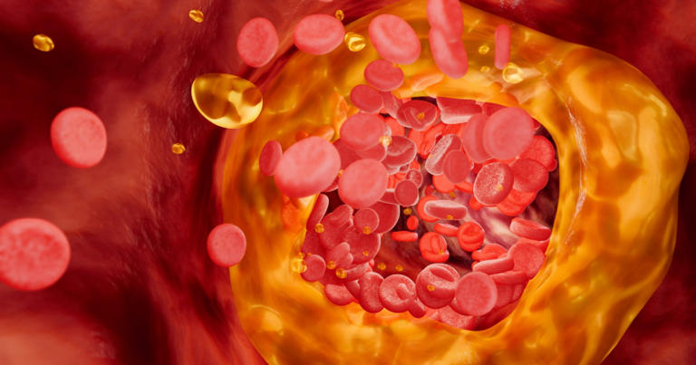 New way to control dangerous artery plaques in heart disease