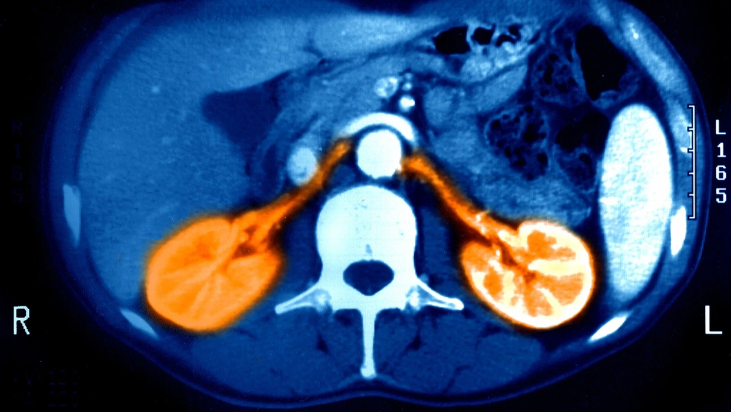 Doctors urge NHS to adopt urine test for early CKD detection