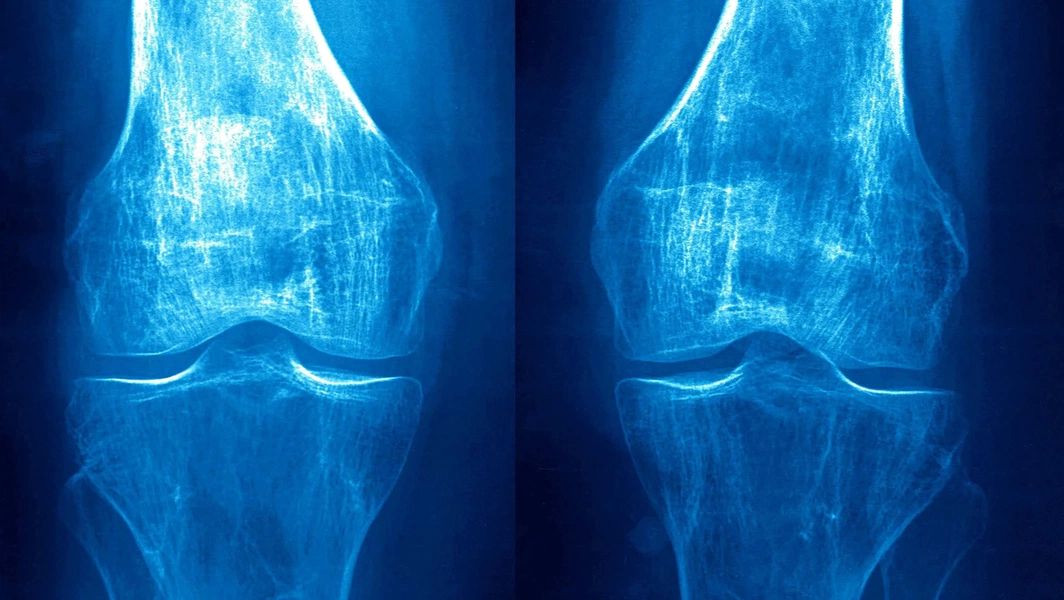 Doctors weigh benefits and risks of 'pounding the stairs' for bone health