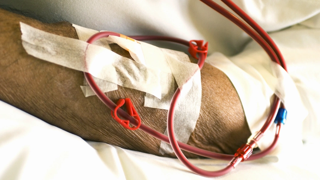 Doctors urge NHS to adopt urine test for early CKD detection