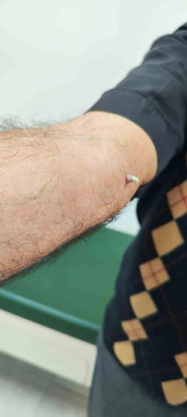 Kolundaki yara için gitti, kanser olduğunu öğrendi