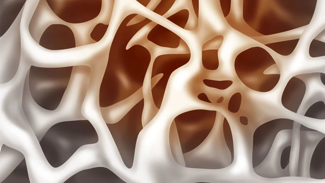 Doctors split on 'pounding the stairs' for bone health