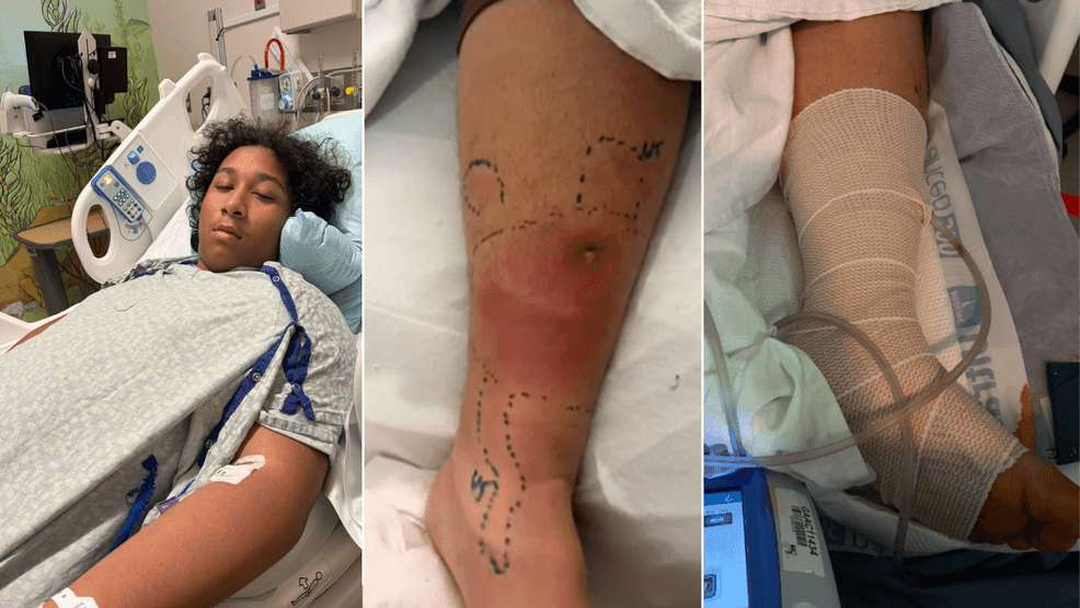 Niceville teen fights for life after Vibrio infection linked to Lions ...