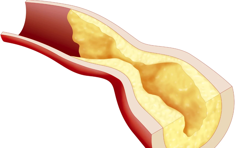 Immune-based therapy shows promise in reducing artery plaque