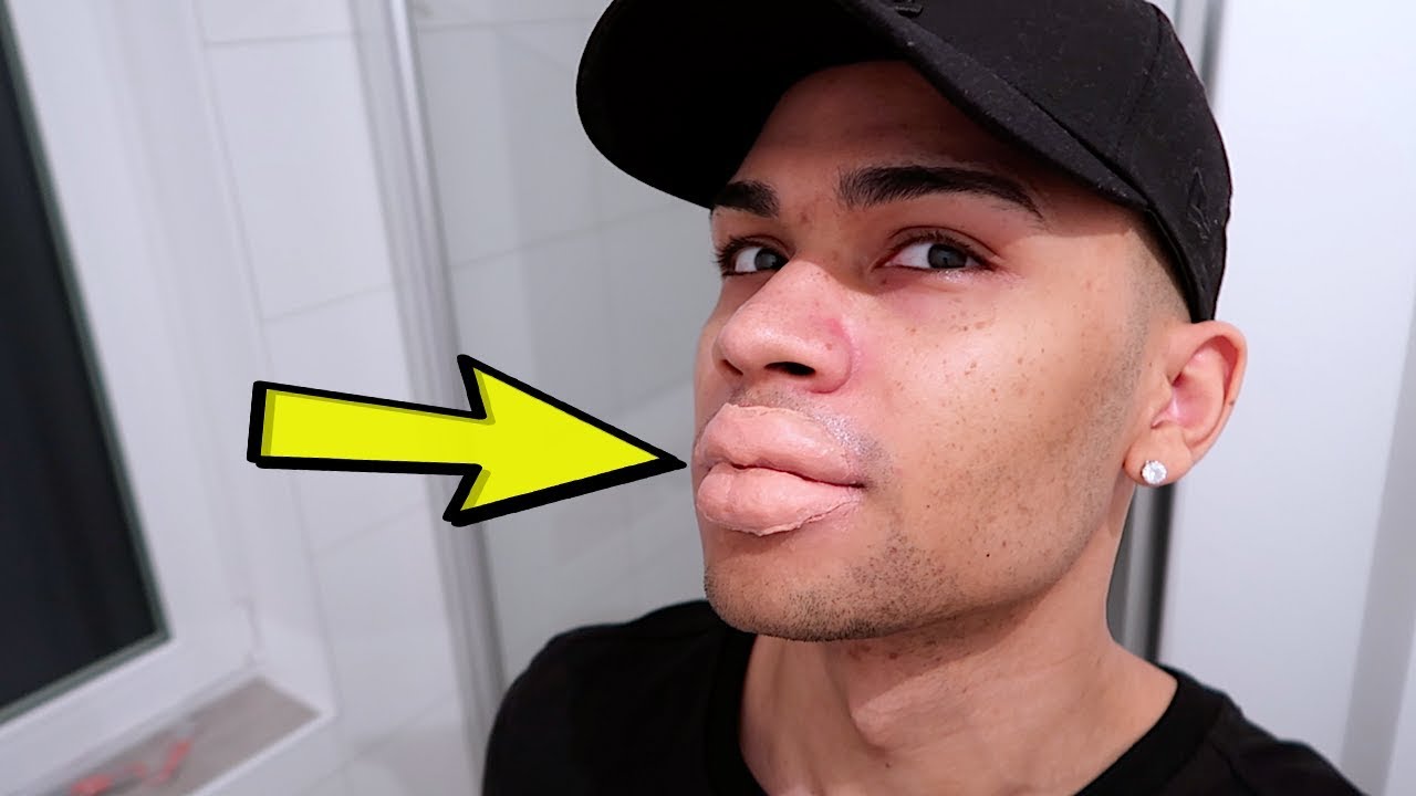 Lippen aufgespritzt prank! | Kelvin und Marvin