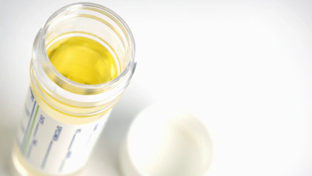 Doctors urge NHS to adopt urine test for early kidney disease detection