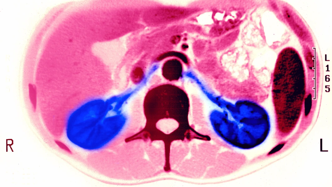Doctors urge NHS to adopt urine tests for early CKD detection