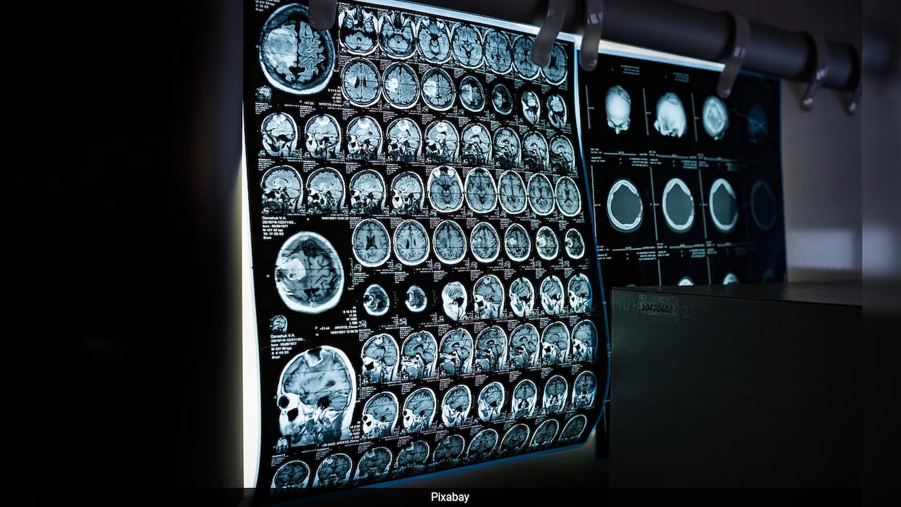 Doctors remove tumour from woman's brain as she watches Pawan Kalyan film