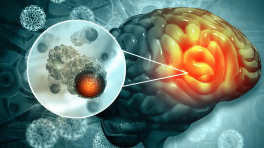 Brain tumour symptoms are often ignored for months - neurosurgeon warns ...