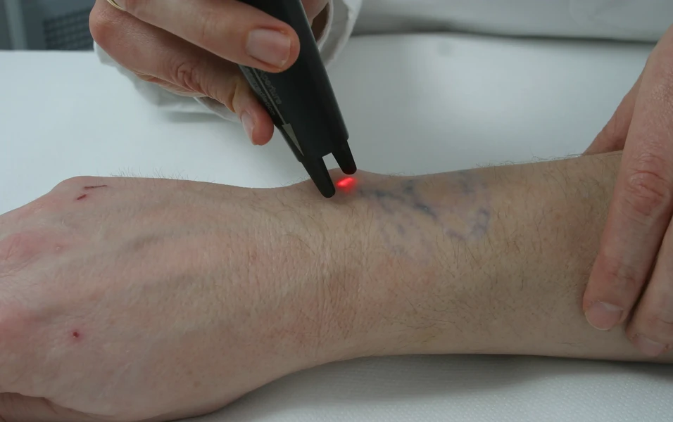 Laser treatments for glowing melanin-rich skin