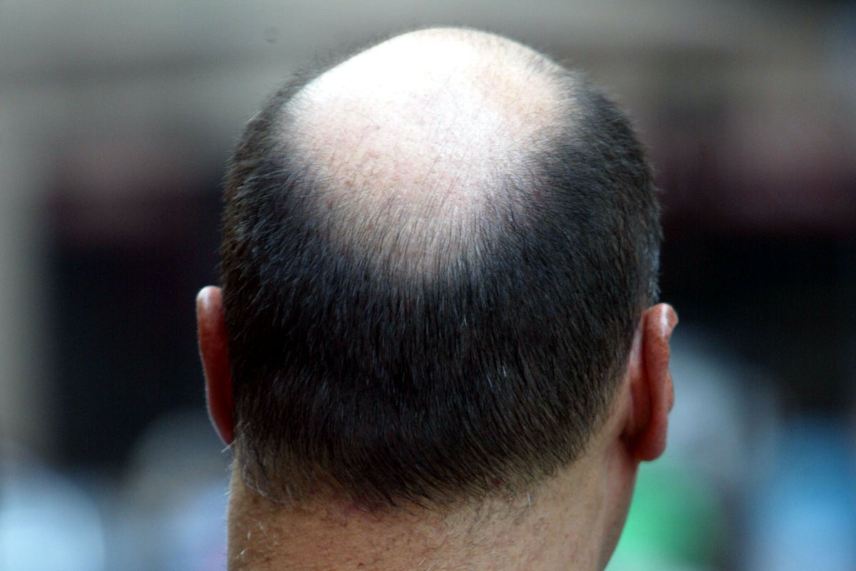 The ancient Chinese herbal remedy that transforms hair loss
