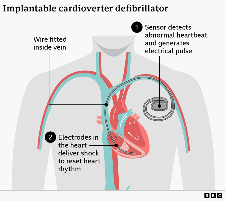 How Eriksen's heart device kicked into action