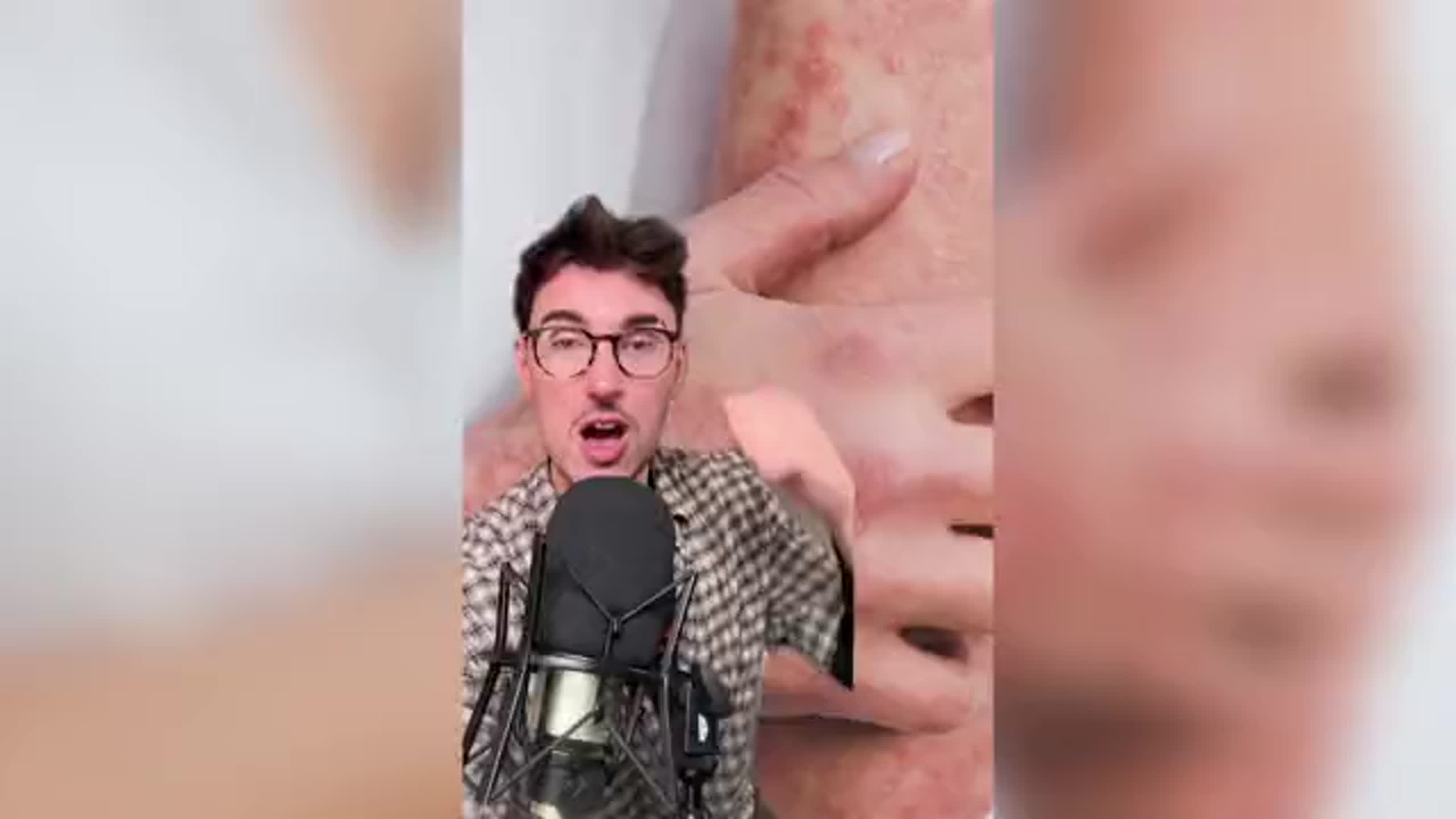 I have psoriasis and scientists think they might've found the cause