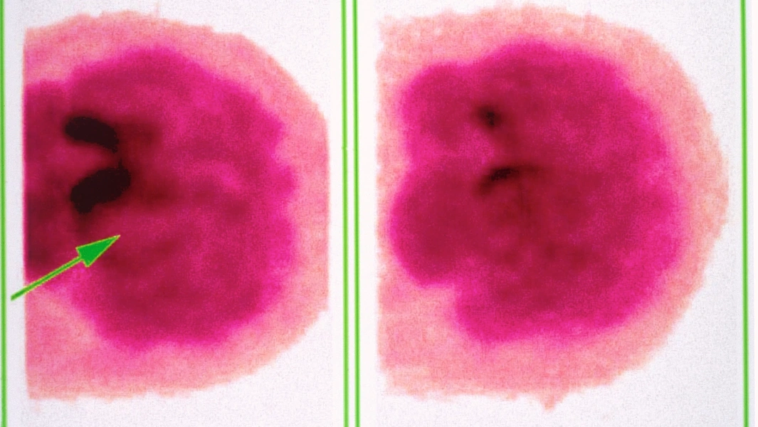 Thalamus size found to predict future memory decline risk