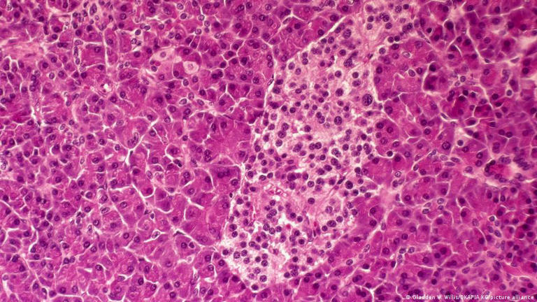 Pancreatic cancer: New drug extends lives but isn't a cure