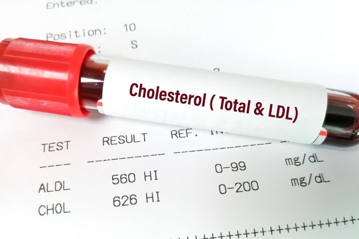 The cholesterol myth doctors are finally admitting was wrong