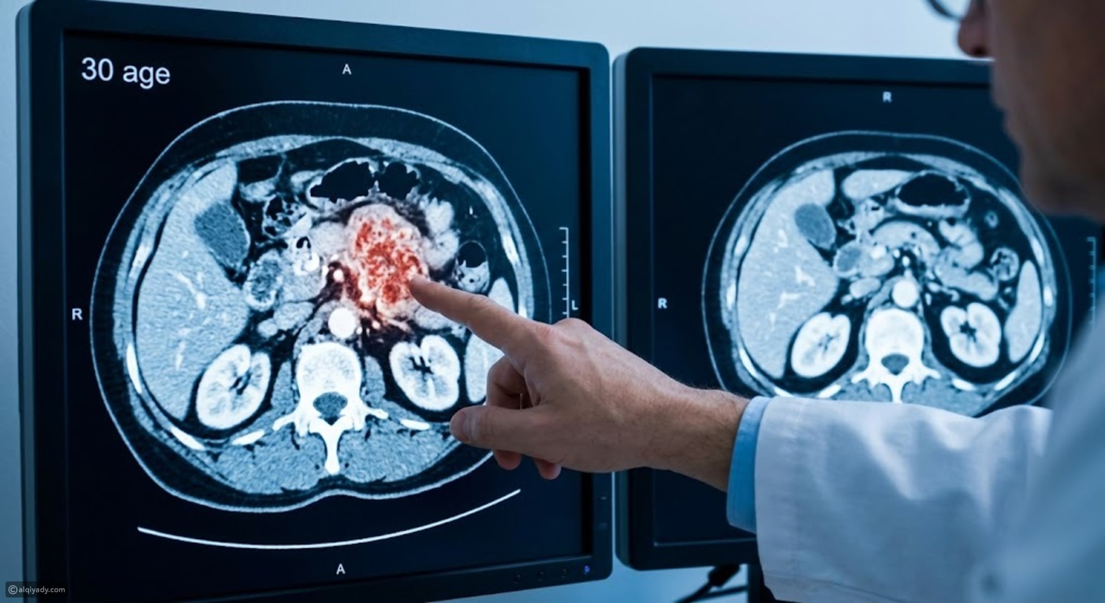 Scientists discover why young people develop colon cancer — a common ...