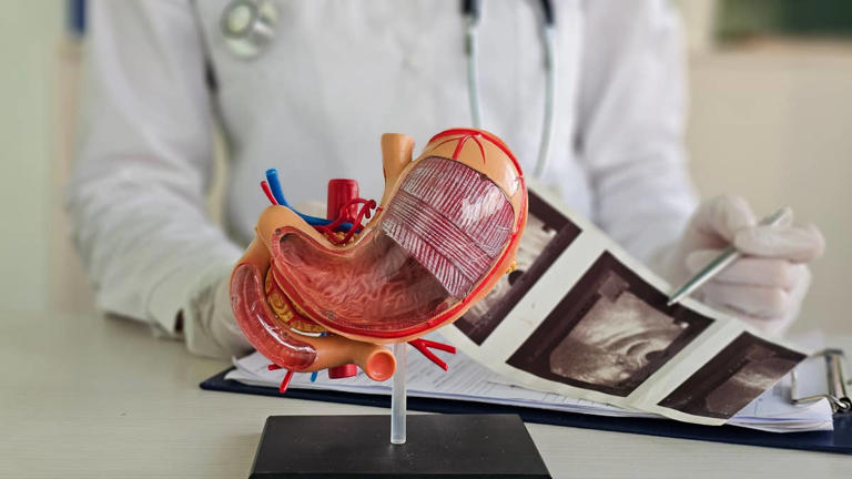 Top gastroenterologist reveals key questions to diagnose bloating in ...