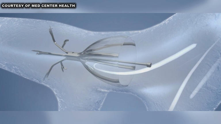 Med Center Health uses thumbnail-sized valve to treat severe emphysema
