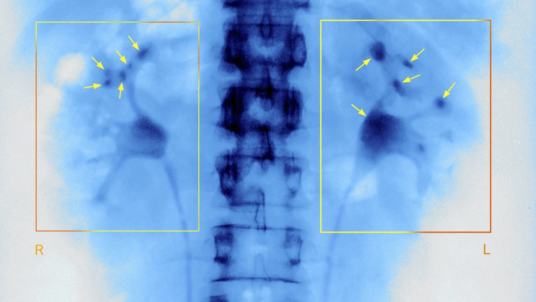 Simple daily habits can significantly lower kidney stone risk