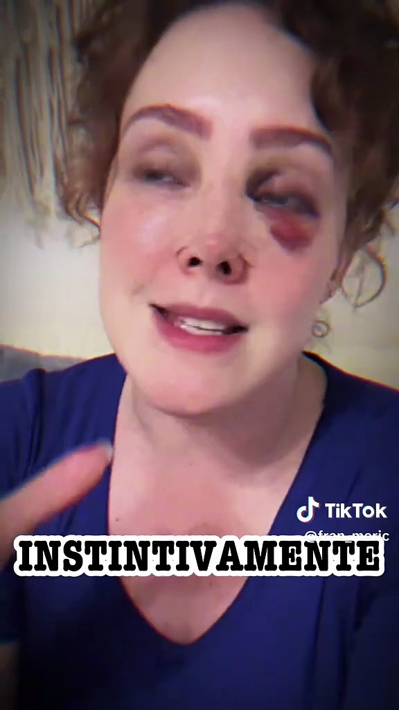 Presentadora de televisión aparece con el ojo morado y confiesa la razón