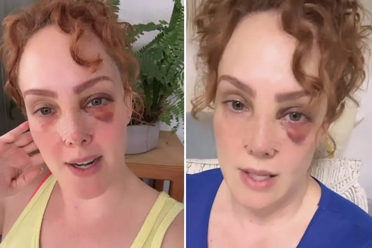 Fran Meric preocupa al aparecer con un ojo morado y golpes