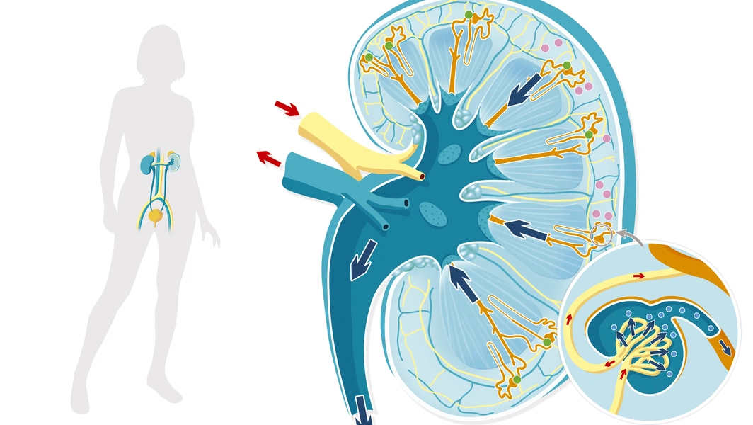 Half of chronic kidney disease cases remain undiagnosed, review finds