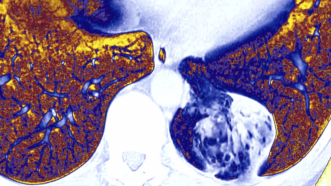 Breathing easier with new lung care breakthroughs