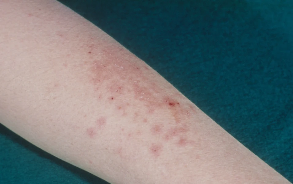 Living better with atopic dermatitis care tips