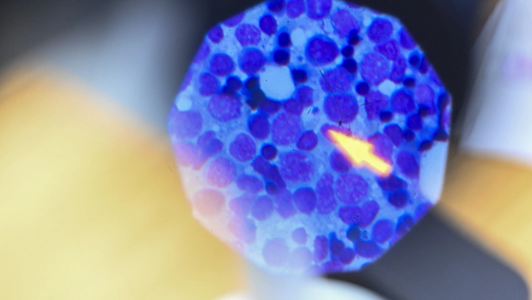Early warning signs and symptoms of leukemia